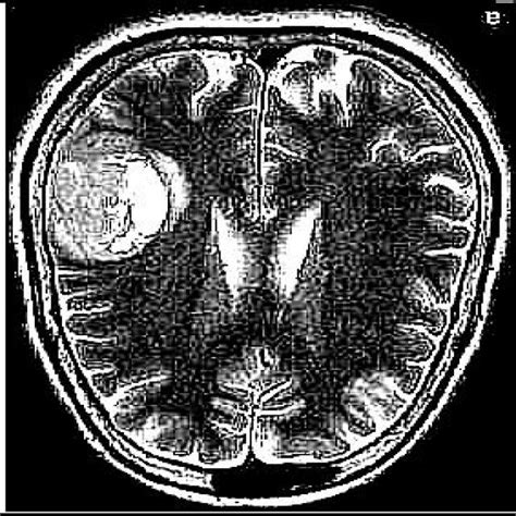 Brain Tumor Detection Object Detection Model By Workspace