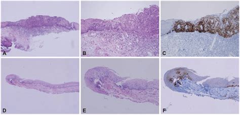 Microscopic Findings Of The Resected Lesion Top Right Pyriform