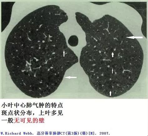 肺大泡肺气肿肺气囊囊肿空洞CT如何鉴别 MedSci cn