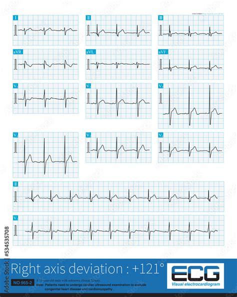 When The Electrical Axis Deviates To The Right The Maximum Qrs Vector