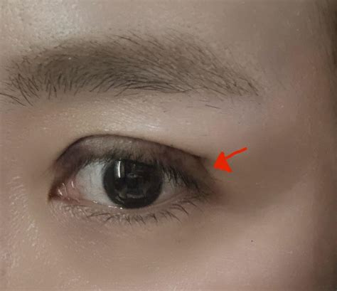 시술 수술 질문 7일에 쌍커풀 재수 강남언니 1등 성형수술and피부시술 정보앱