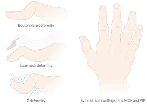 Rheumatoid Flashcards Quizlet