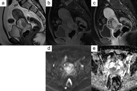 Lobular Endocervical Glandular Hyperplasia And Related Glandular