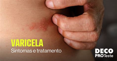 Varicela Quais Os Sintomas E Como Tratar Deco Proteste