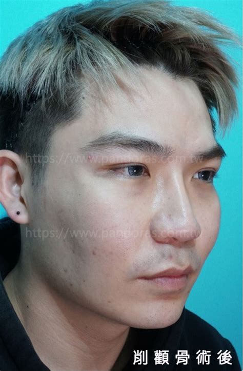 台中顴骨內推手術、削顴骨整形｜潘朵拉醫美整形