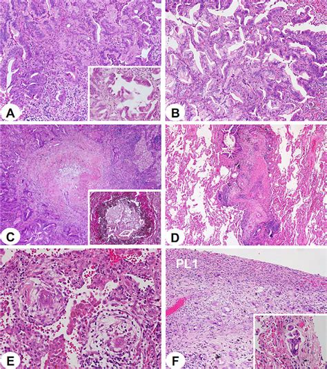 A F In The Lung Invasive Mucinous Adenocarcinoma Featured Acinar Download Scientific