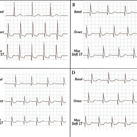 A E D Stored Intracardiac Electrograms Showing Ischaemia Related