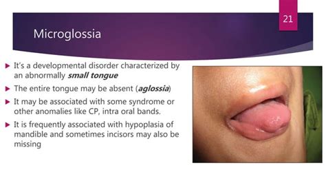 Developmental Defects Of Oral And Maxillofacial Region Pptx Dental Health Diseases And