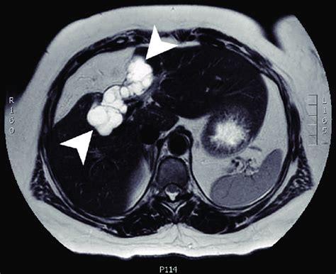 Hcc Eovist Radiology At Lawrence Henry Blog