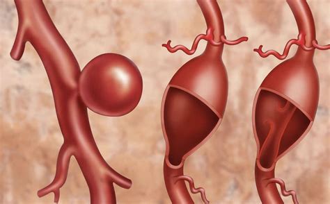 Aortic Aneurysm What Is An Aortic Aneurysm