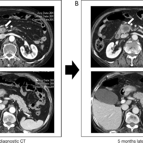 A Case Of Distal Pancreatic Atrophy Without Pancreatic Duct Dilatation