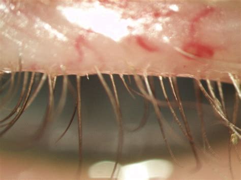 Demodex Blepharitis