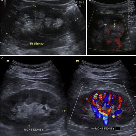 A Diffuse Hyperechogenicity Of Renal Medulla On B Mode