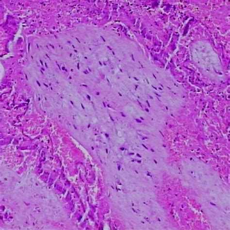 Histopathological Findings Of A Hepatic Ectopic Pregnancy Download Scientific Diagram