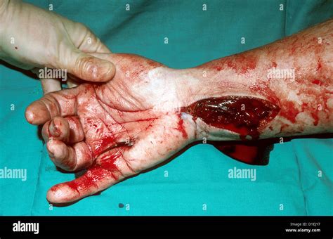 Arm Lacerations