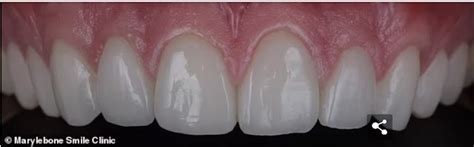 What Bts Jins Teeth Say About His True Personality According To A Dental Expert Koreaboo