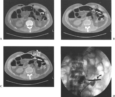 Percutaneous Gastrostomy Gastroenterostomy And Jejunostomy