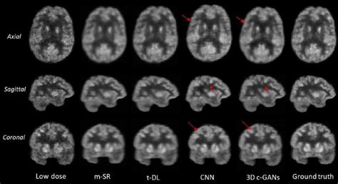 Deep Neural Networks Synthesize Full Dose PET Images Physics World