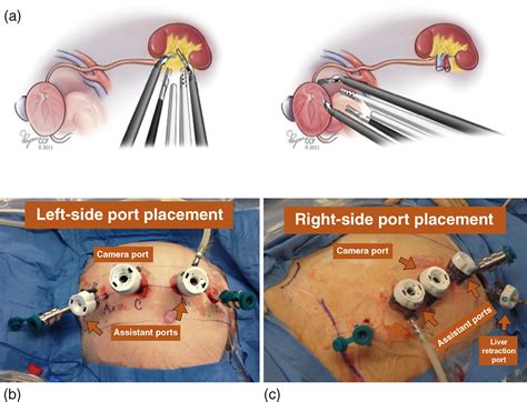 Robotic Nephroureterectomy A Simplified Approach Requiring No Patient Repositioning Or Robot