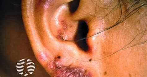 Chronic Discoid Lupus Erythematosus Image