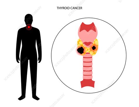 Thyroid Cancer Illustration Stock Image F036 3926 Science Photo
