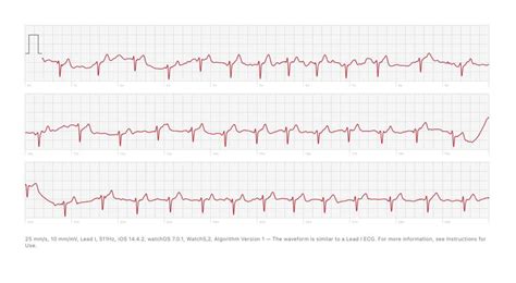 81 Best R Readmyecg Images On Pholder Camping Update Now Apple Watch Saying Atrial