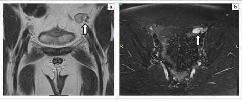 Figure 1 From Abnormal Descent Of The Testis And Its Complications A Multimodality Imaging