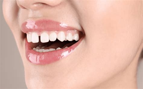How To Get Rid Of That Embarrassing Gap In Your Teeth