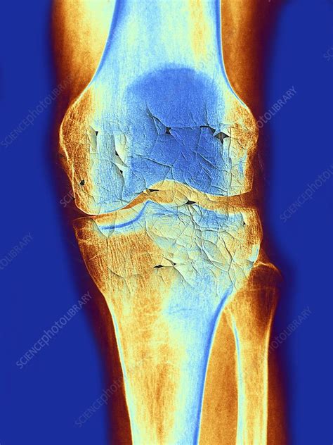 Knee Joint X Ray Artwork Stock Image F0069190 Science Photo