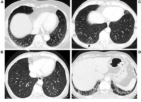 Figure From Effect Of Interstitial Lung Abnormality On Concurrent