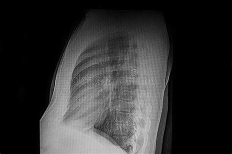 Lateral Cxr Stock Illustrations 1 Lateral Cxr Stock Illustrations