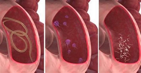 დაცალეთ მსხვილი ნაწლავი პარაზიტებისგან ყველაზე მარტივი თუმცა ეფექტური მეთოდით რჩევები