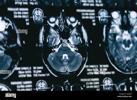 Scansione Del Cervello Immagini E Fotografie Stock Ad Alta Risoluzione