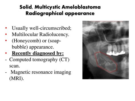 Odontogenic Tumors Dr Wafaa Khalil جراحة خامس اسنان د وفاء م 17