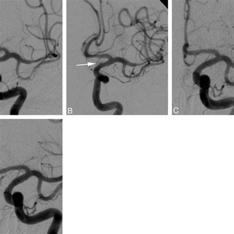Left Supraclinoid Ica Blister Aneurysm Preprocedure Dsa A Shows A