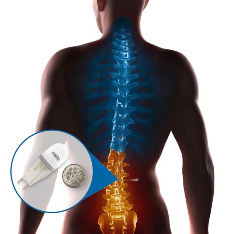 Nalu Medical Gilde Healthcare