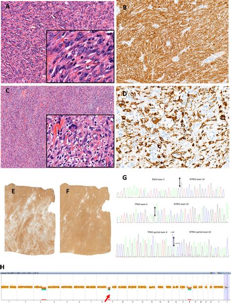 Uterine And Vaginal Sarcomas Resembling Fibrosarcoma A