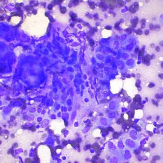 Diff Quik Stain FNA Smear From The Breast Mass Showing A Download Scientific Diagram