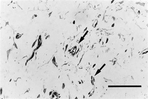 Light Microscopic Findings Of Proliferative Membrane Main Components