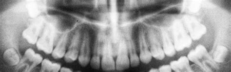 Biaya Rontgen Gigi Dan Kapan Melakukannya Klinik Gigi SATU Dental
