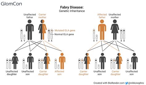 Fabry Disease Spotting The Zebra Amongst Horses Glomcon Pubs