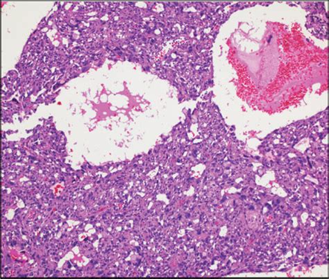 Microcystic Stromal Tumor Mst Of The Ovary A Solid Nodule With
