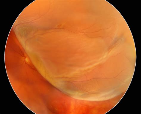 Retinal Detachment