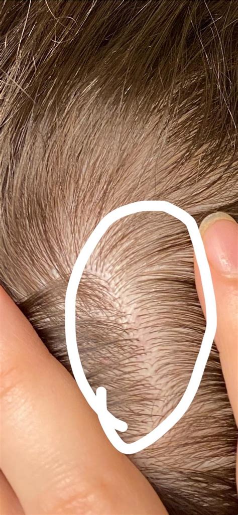 Is This Pink Patch Scarring Alopecia Or Irritation From Brushing My Hair Prior What Does