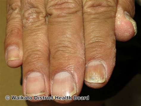 Tinea Manuum Wikiprojectmed