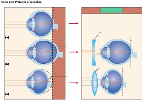 Problems Of Refraction Corrections Diagram Quizlet