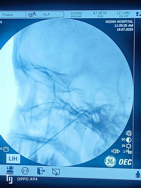 Khalid Al Rawahi On Linkedin Case Of Left Sided Trigeminal Neuralgia Mainly Second And Third