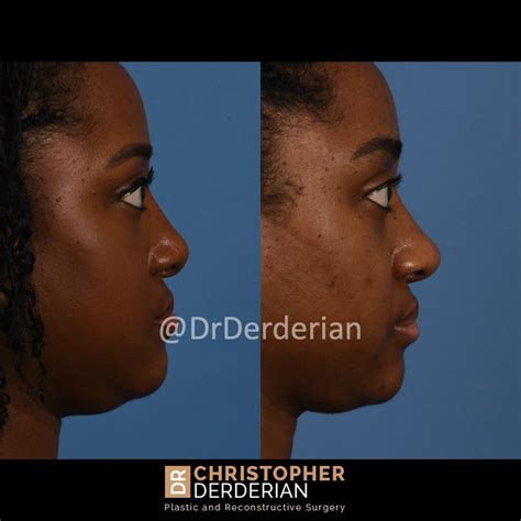 Cleft Rhinoplasty — Dr Derderian — Plastic And Reconstructive Surgery