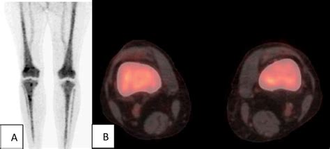 A B Diffusely Increased FDG Uptake Within The Long Bones Of The