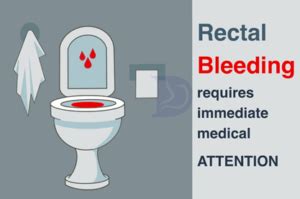 Rectal Bleeding Digestive And Liver Health Specialists